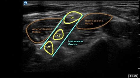 Infraclavicular Block Ultrasound