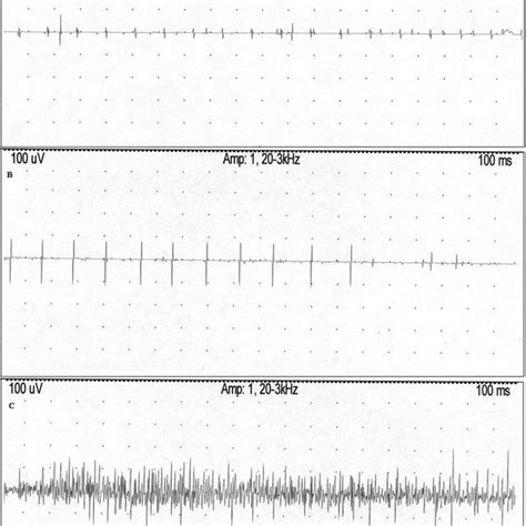 Motor Unit Action Potentials A Fibrillation Potentials Recorded