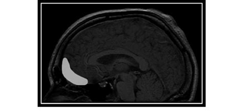 Orbitofrontal Cortex Ofc Prefrontal Cortex Pfc Region In The Front Download Scientific
