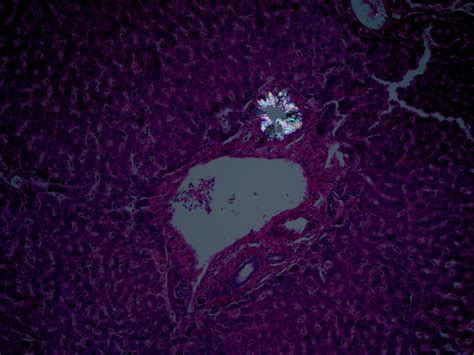 Pathology Outlines Primary Hyperoxaluria