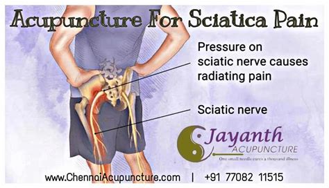 Acupuncture Treatment For Sciatica In Chennai At ₹ 600 Session In Chennai Id 20912877948