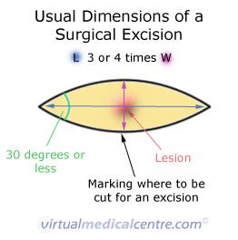 Skin Biopsy To Diagnose Skin Cancer
