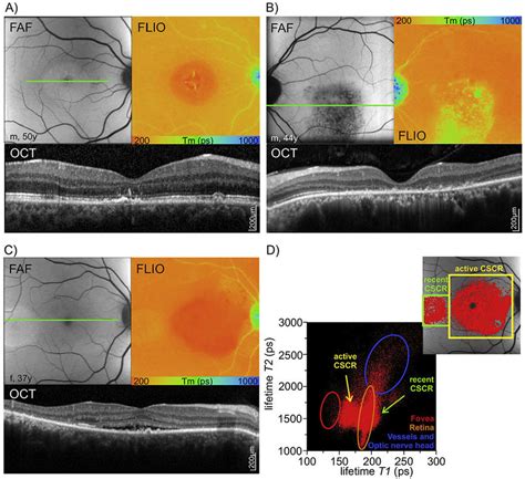 Autofluorescence Lifetimes In Central Serous Chorioretinopathy Cscr