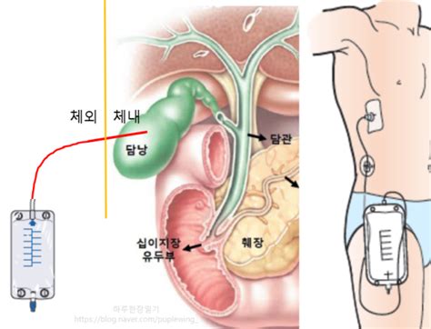 Gbcbd Stone Cholecystition Cholangitis 간호사가 알아야 할 Ercp A7