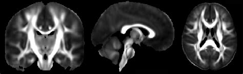 Dti Tutorial 2 Normalization And Statistics Diffusion Imaging