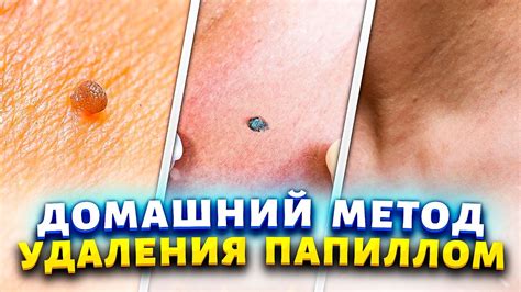 Папилломы бородавки шипицы боятся этого средства Как удалить папиллому гелем Папилофаг Youtube