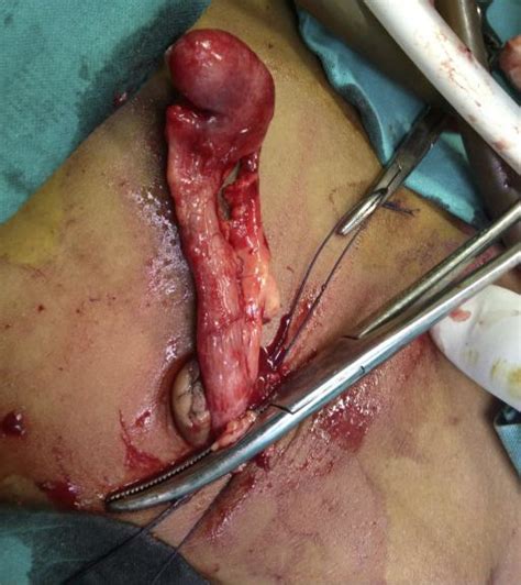 Markedly Inflammed Appendix Delivered Transumbilically Download Scientific Diagram