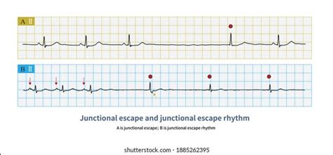 Junctional Bradycardia Rhythm Strip