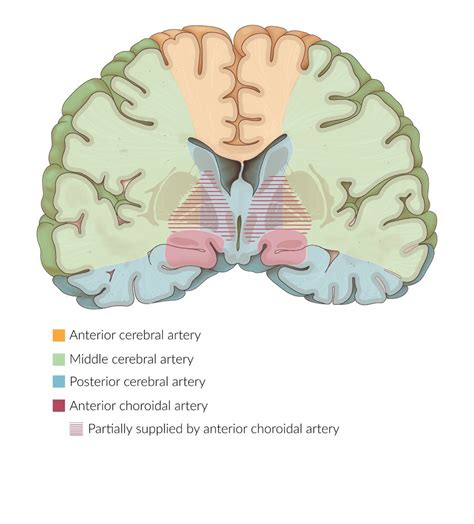 Posterior Cerebral Artery Stroke Illustration Of Homoregional