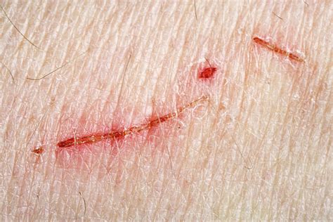 Skin Scratch