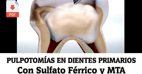 Pdf Pulpotomías Con Sulfato Férrico Y Mta En Dientes Primarios Serie