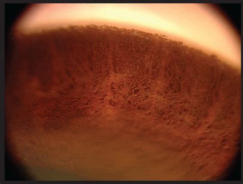 Iris Processes Gonioscopy Angle