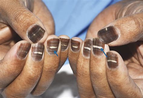 What Causes Black Spots On Your Fingernails At Jill Ford Blog