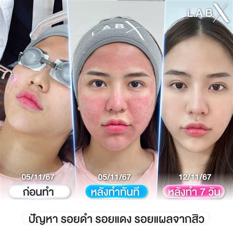 Labx Laser Center เลเซอร์ Pico หน้าใส หลุมสิว ฝ้า กระ Nonthaburi
