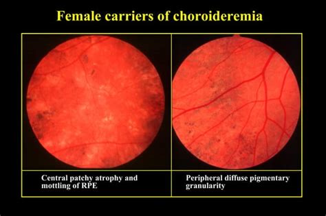 47 Hereditary Choroidal Dystropathies Ppt Eye And Vision Conditions Diseases And Conditions