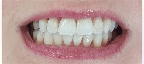 Beautiful Aligned Teeth With Invisalign Treatment Before And After Photos