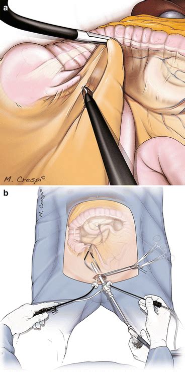 Right Colectomy Abdominal Key