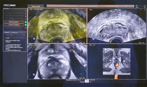 Biopsia Della Prostata Dott Zito
