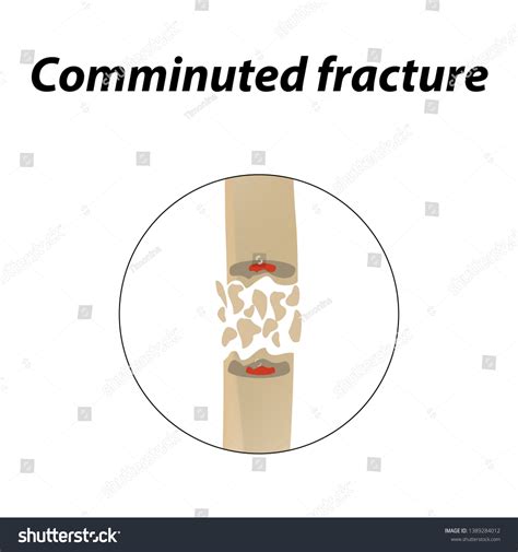 Comminuted Fracture Bone Infographics Illustration On Stock Illustration Shutterstock