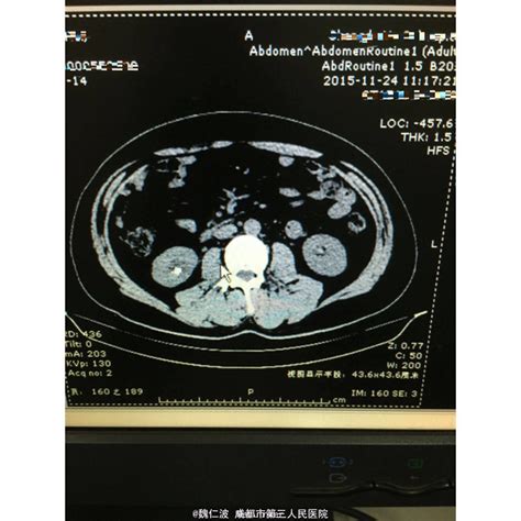 输尿管结石术后输尿管闭锁一例 医联