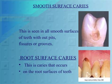 Aetiopathology And Classification Of Caries Ppt