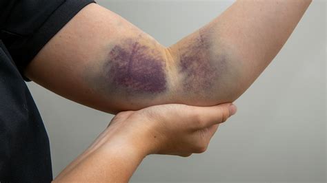 Contusions First Aid Glossary