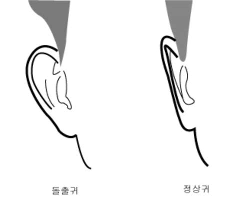 보나성형외과 Q 쪽박귀는 어떤 귀일까 A 👨‍⚕ 쪽박귀는 귀안 Y자 주름이 잘 형성되지 않고