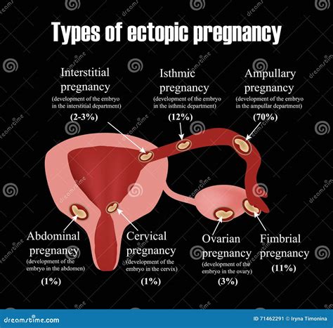Uterus And Types Of Fibroids Vector Illustration 35849036