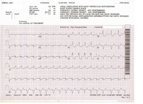 Rapid Atrial Fibrillation Strips Ekg Interpretation Cheat Sheet