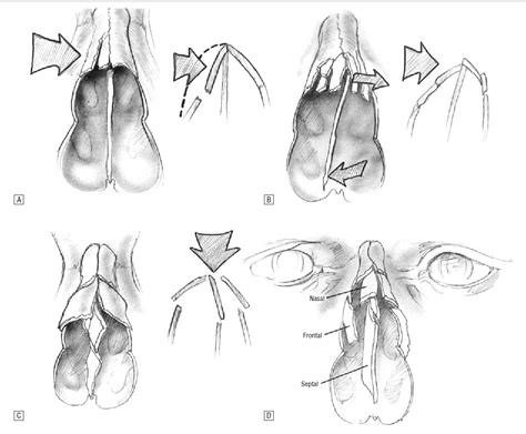 Figure 3 From Management Of Nasal Fractures Semantic Scholar