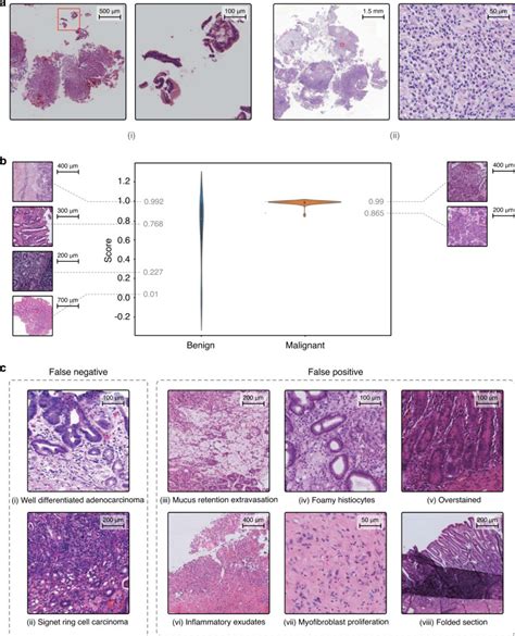 Clinically Applicable Histopathological Diagnosis System For Gastric