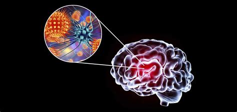 Understanding Encephalitis The Inflammation Of The Brain Happiest Health