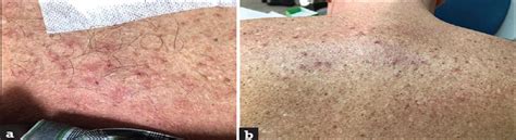 Transient Acantholytic Dermatosis New Dermatoscopic Feature Indian Journal Of Dermatology