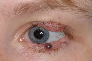 Nevus Naevus