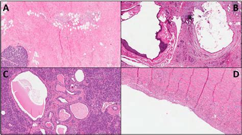 Important Histological Patterns Of Chronic Pancreatitis A Marked