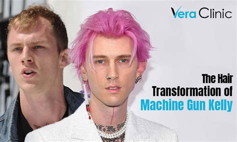 Machine Gun Kelly Hair Transplant Vera Clinic