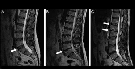 External Validation Of Spinenet An Open Source Deep Learning Model For Grading Lumbar Disk
