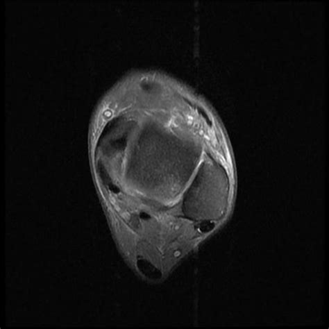 Radiopaedia Case Navicular Fracture Id 91801 Study 109587 Nc Commons