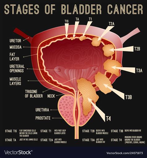 Bladder Cancer Grading