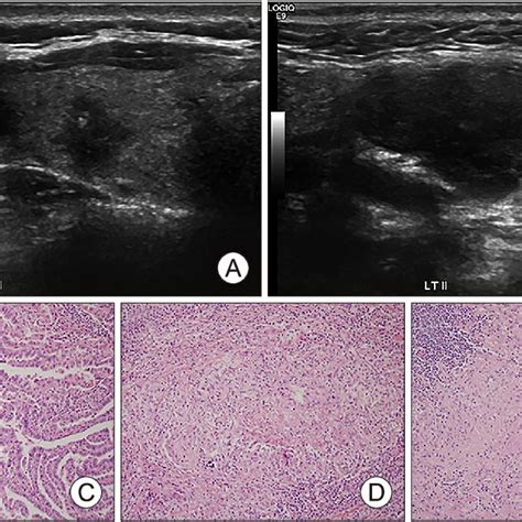 Images And Histological Analysis Of The Thyroid And Lymph Node A