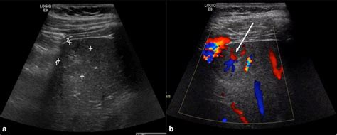 A 31 Year Old Woman With Elevated Liver Enzymes In The Setting Of Oral A 31 Year Old Woman With Elevated Liver Enzymes In The Setting Of Oral