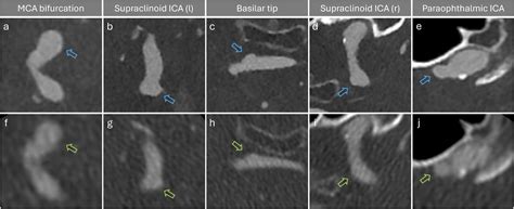 Advancing Neurovascular Imaging Optimization Of Reconstruction Kernel