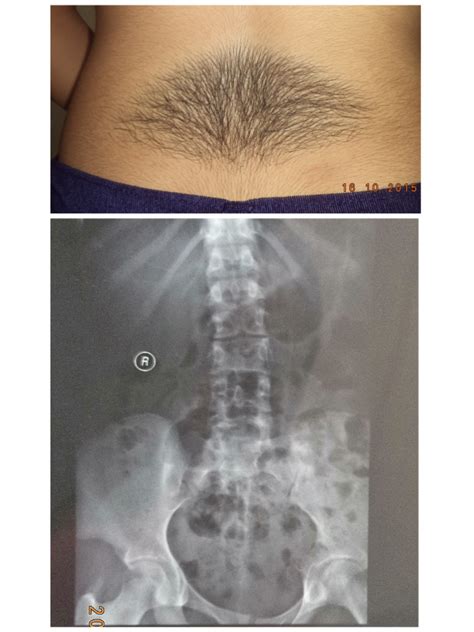 Spina Bifida Occulta Hair Patch