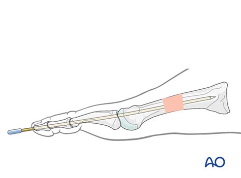 Intramedullary K Wire Fixation For Distal Fractures Of The 5th Metatarsal