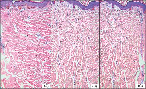 A Collagen Fibers Before Treatment Sclerotic Compacted Thick Download Scientific Diagram