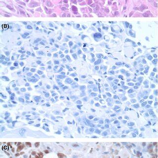Biopsy From An Axillary Lymph Node With Metastasis Of A Poorly Download Scientific Diagram