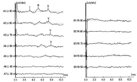 Auditory Brain Stem Response Showing Absence Of The Right Download