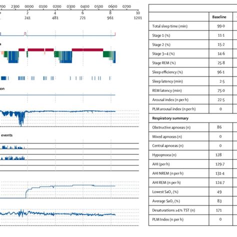 An Example Summary Report From An Overnight Split Night Polysomnography