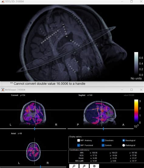 Issue With Seeg Ecog Adding Electrodes Discussions Brainstorm
