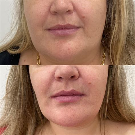 PDO Thread Lift In Newport Beach CA Beauty Boost Med Spa